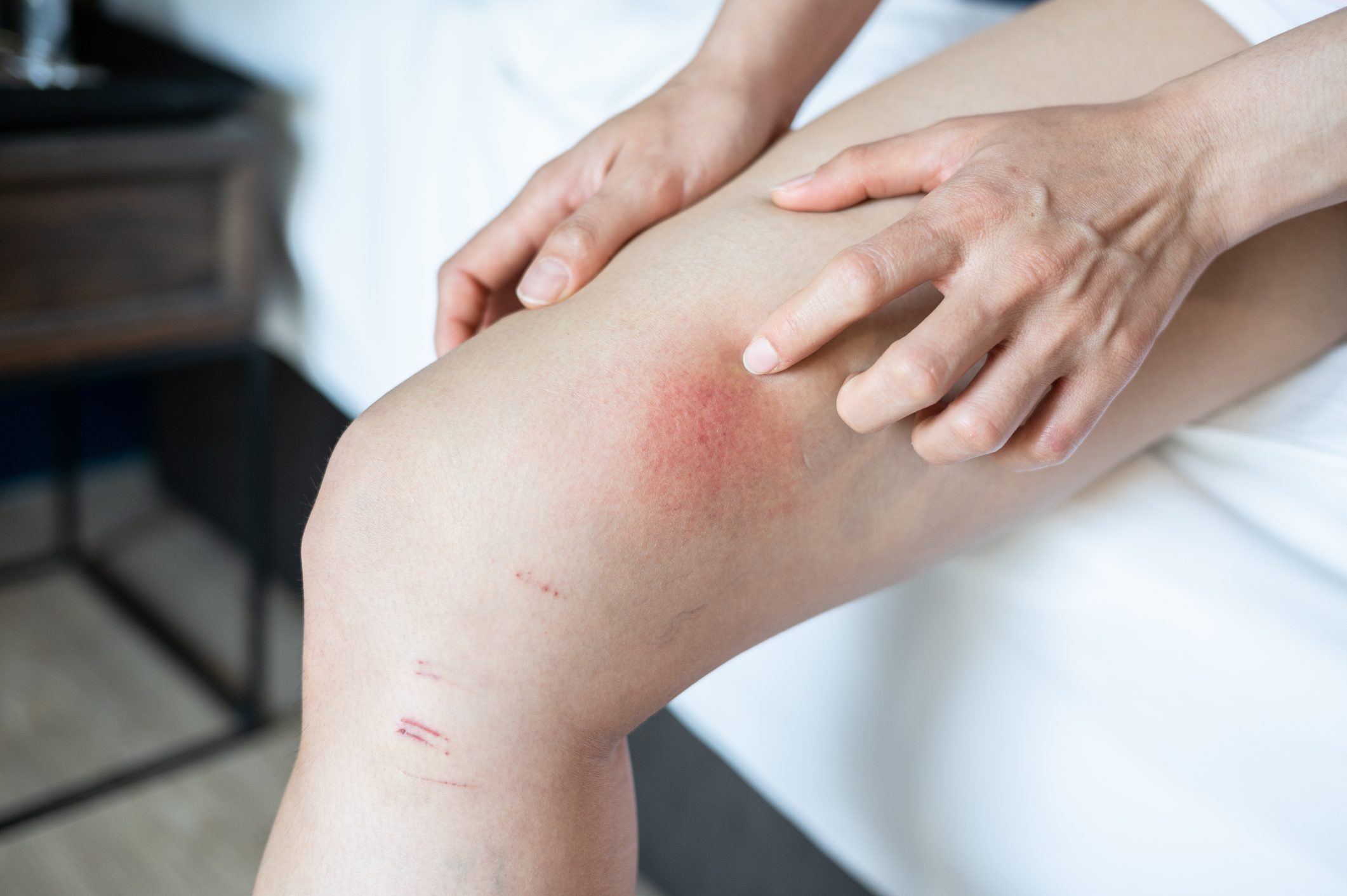 Jock Itch Symptoms Midwest Express Clinic Chicago Northwest IN